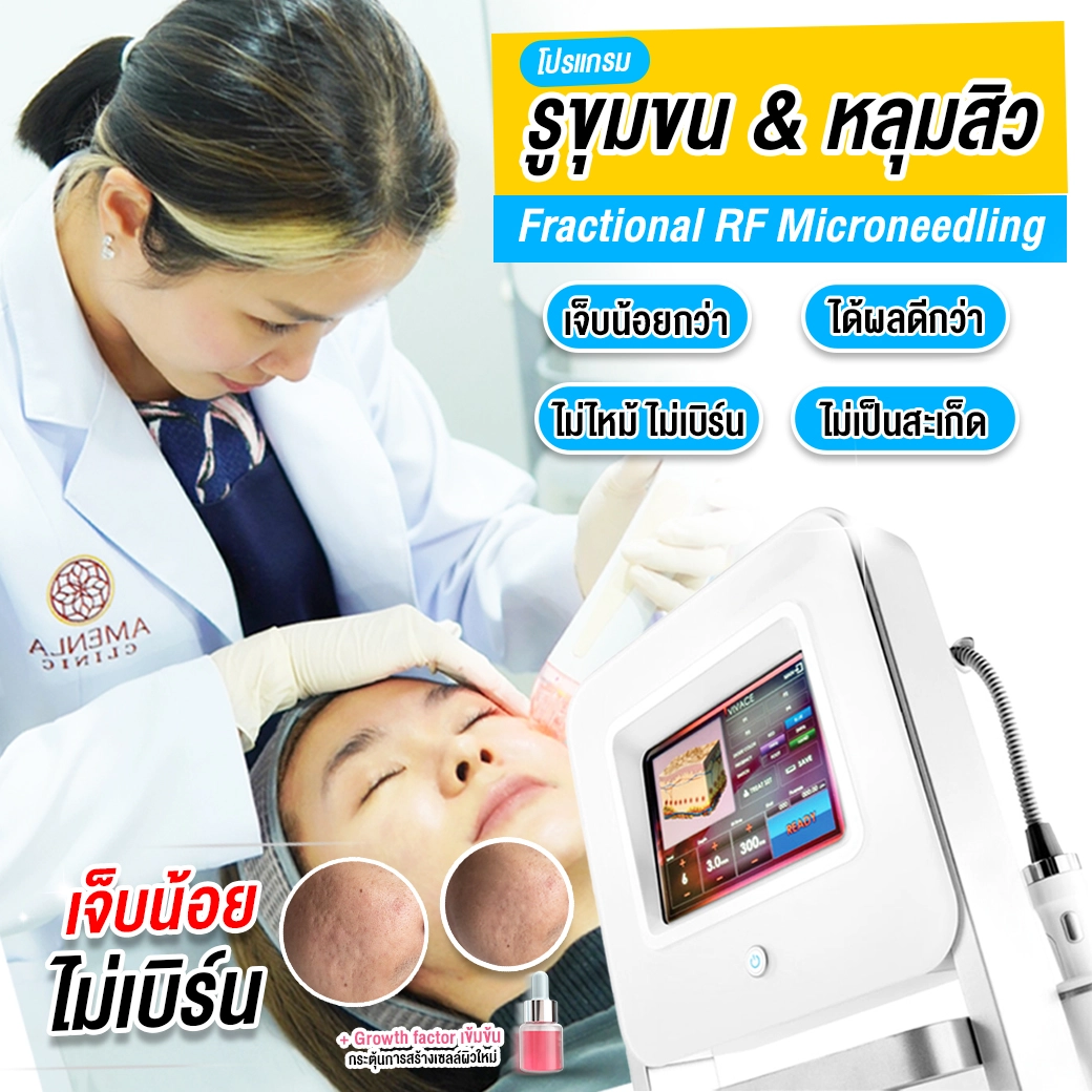 นวัตกรรมการรักษาหลุมสิว ด้วย Vivace ที่ เอเมนร่าคลินิก ! - Amenla Clinic