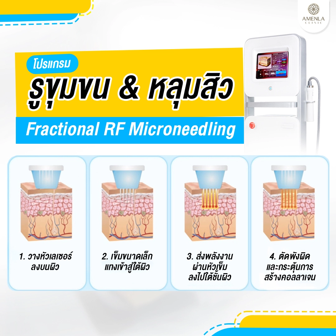 นวัตกรรมการรักษาหลุมสิว ด้วย Vivace ที่ เอเมนร่าคลินิก ! - Amenla Clinic